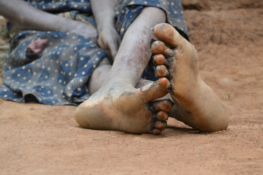 The Tiny Flea Behind a Disease Outbreak in Uganda • Bright Hope